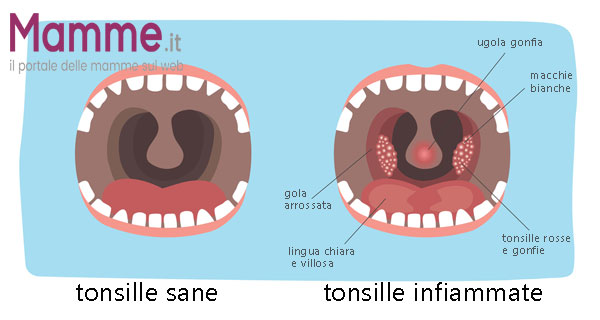 Tonsillite nei bambini: cause, sintomi, rimedi | Mamme.it